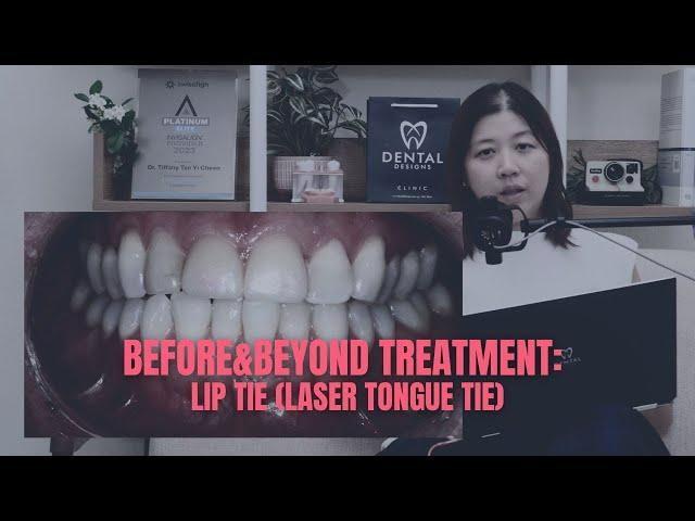 Laser Treatment For Lip Tie Before Beyond Ep24 Case Review